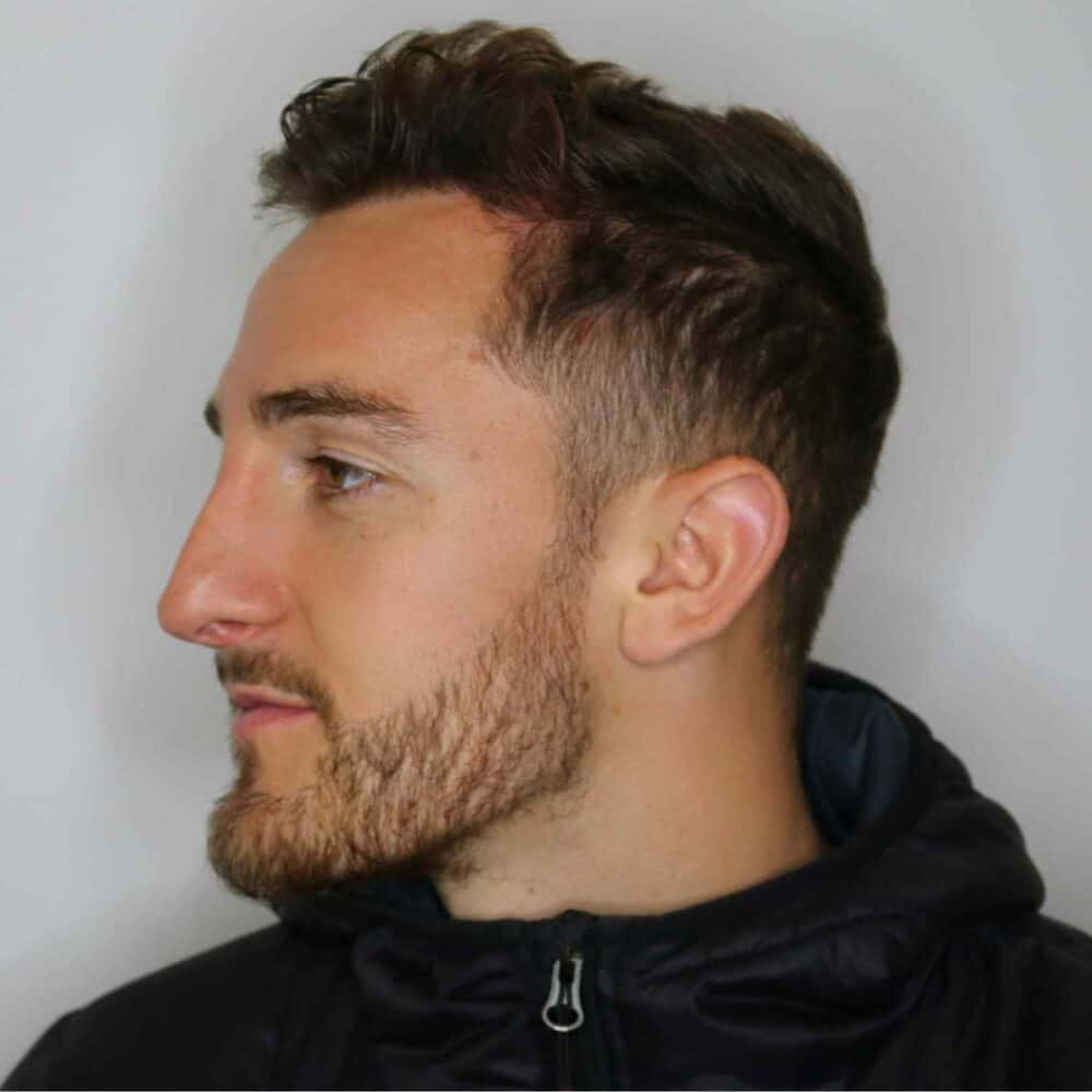 Receding Hairline Stages: The Seven Stages of Baldness