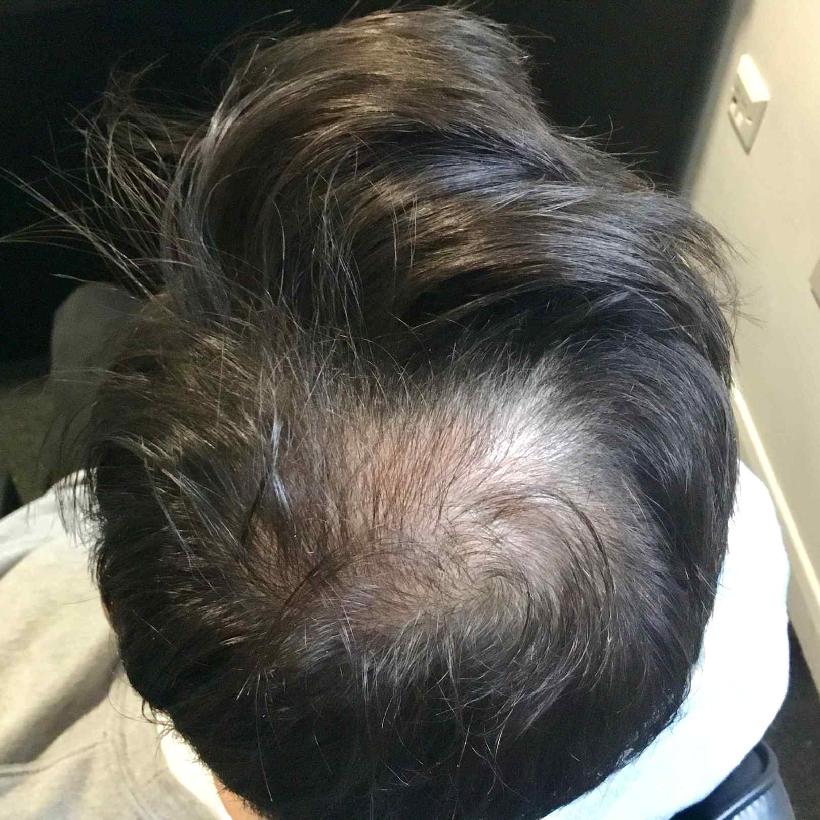 Receding Hairline Stages: The Seven Stages of Baldness