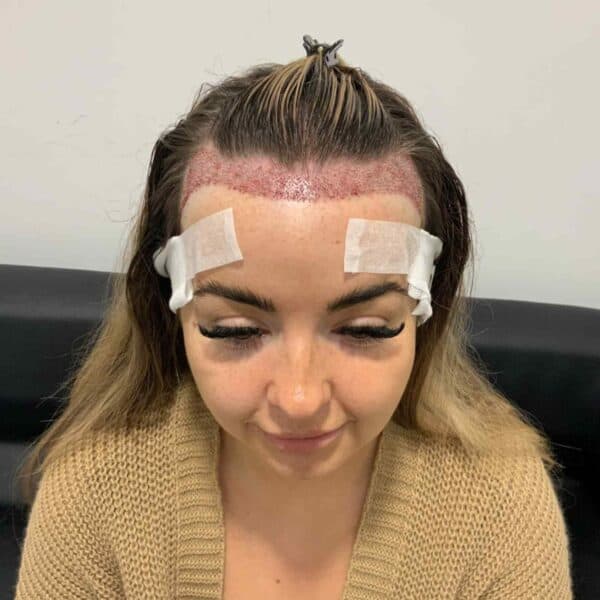Receding Hairline Transplant Before and After | KSL Clinic