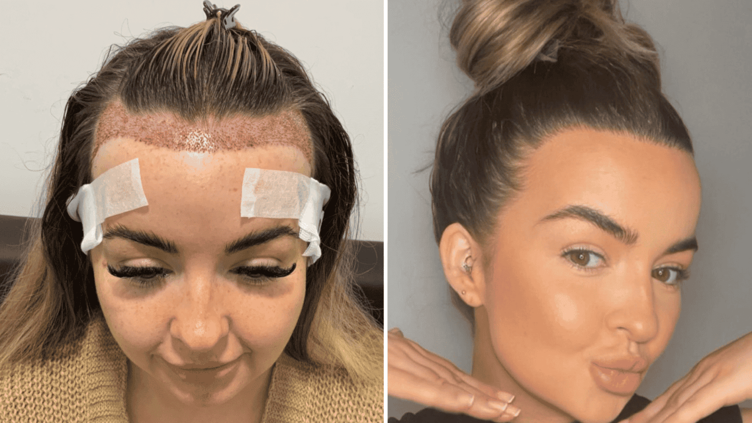 How to Fix a Pushed Back Hairline (Permanently!) - KSL Clinic