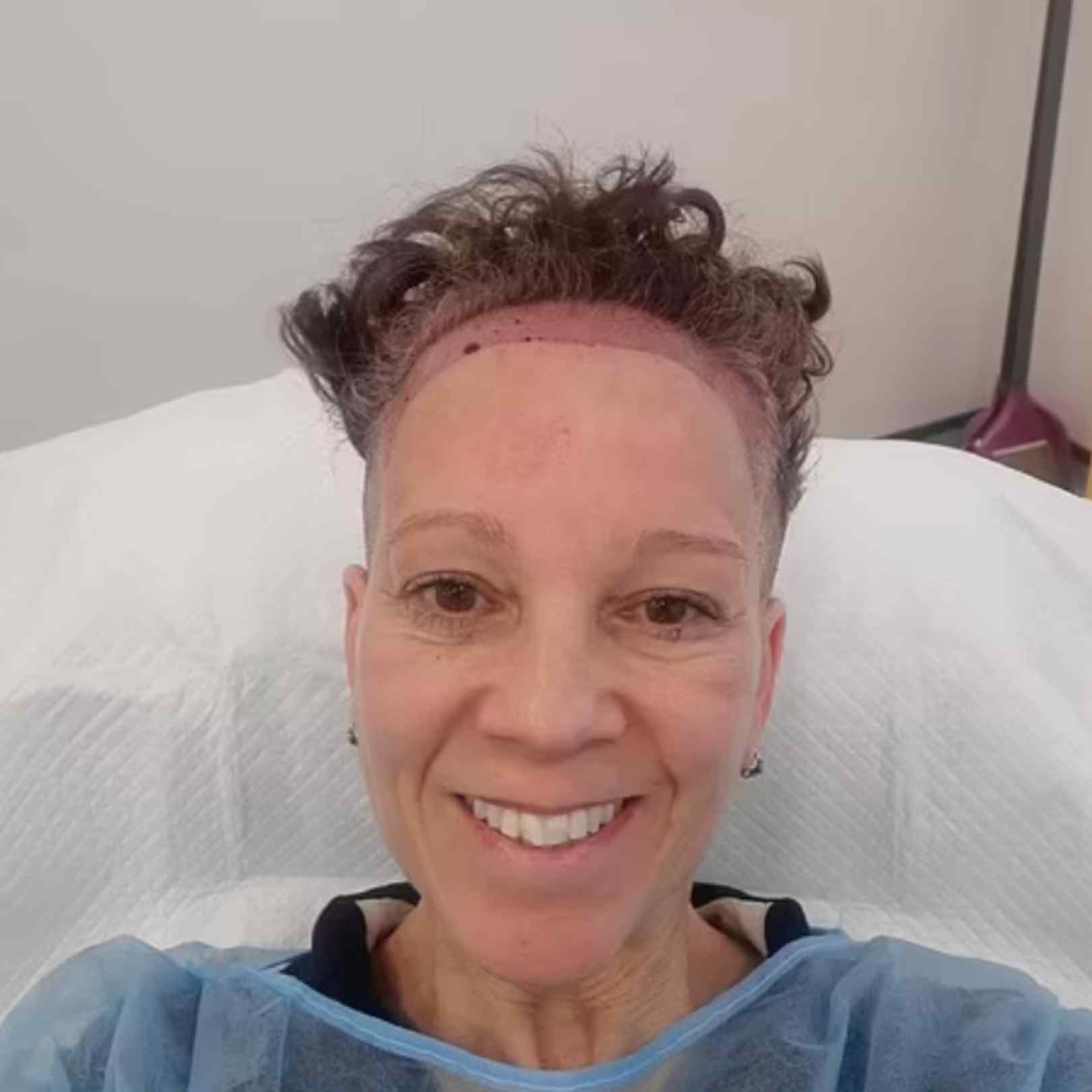 How to Fix a Pushed Back Hairline (Permanently!) - KSL Clinic