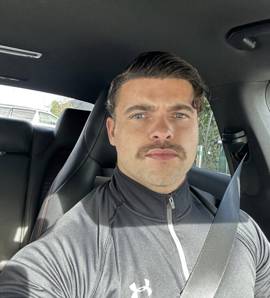 Jake Cornish Hair Transplant at KSL Clinic // See the results here