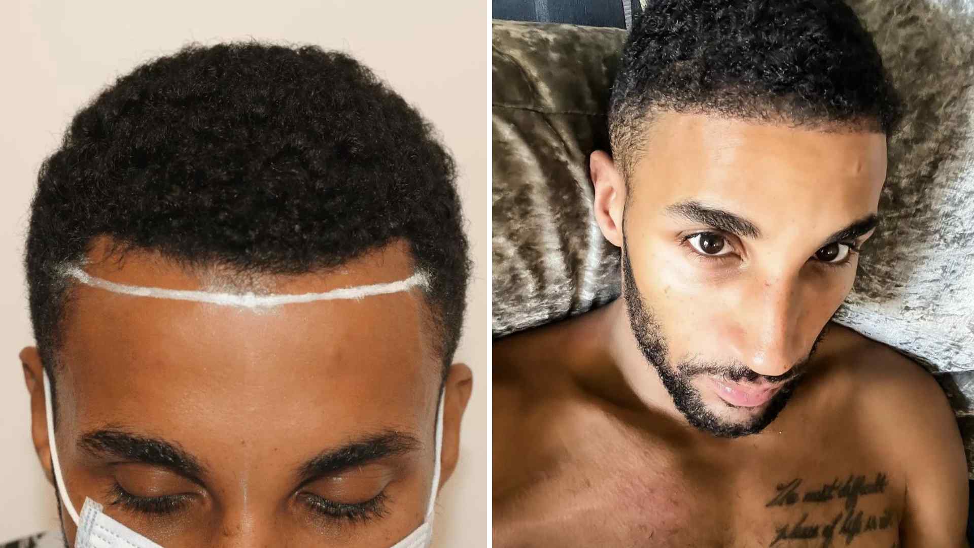 Uneven Hairline? Your 'Wonky Hairline' Treatment Options