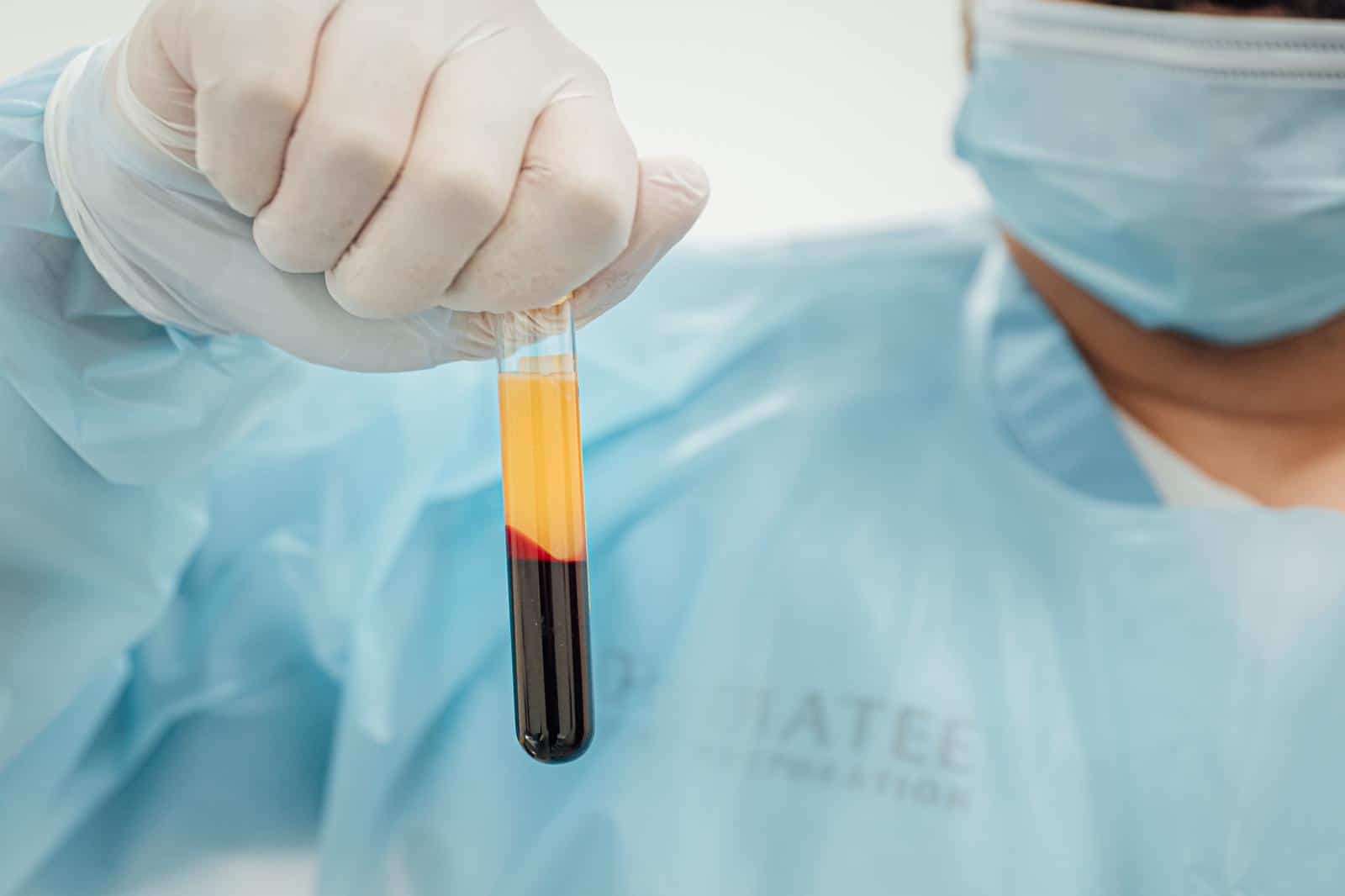 Prp After Hair Transplant Why And The Benefits