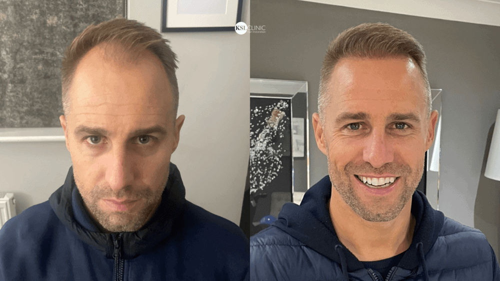 Uneven Hairline? Your 'Wonky Hairline' Treatment Options
