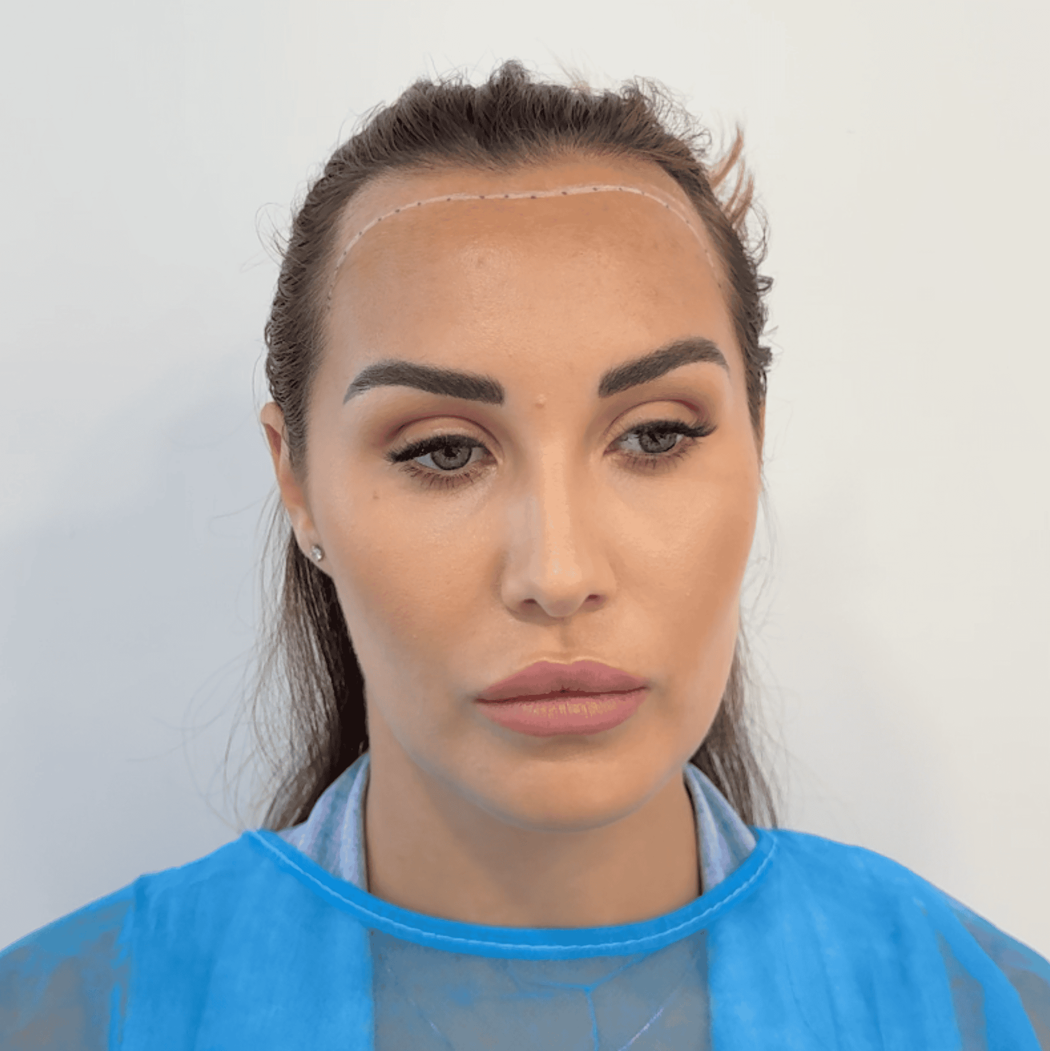 Chloe Goodman Hair Transplant at KSL Clinic // See the results here