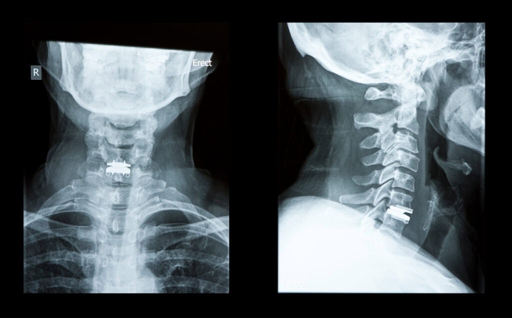 Cervical Disc Replacement - Yellowstone Sports Medicine