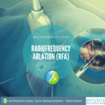 Radiofrequency Radioablation | Effective Treatment To 60%