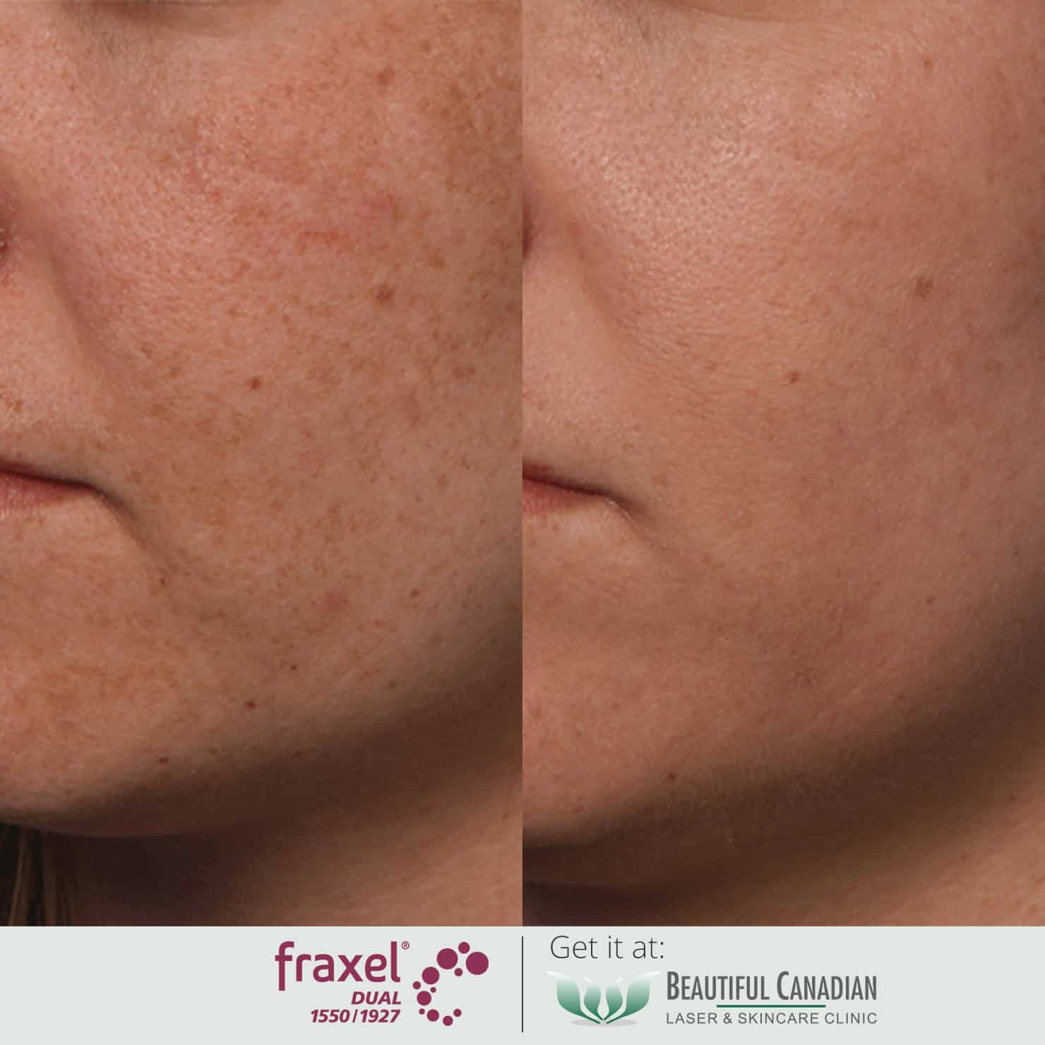 Vancouver Fraxel® DUAL Laser (in Surrey) | Skin Tone & Anti-Aging ...
