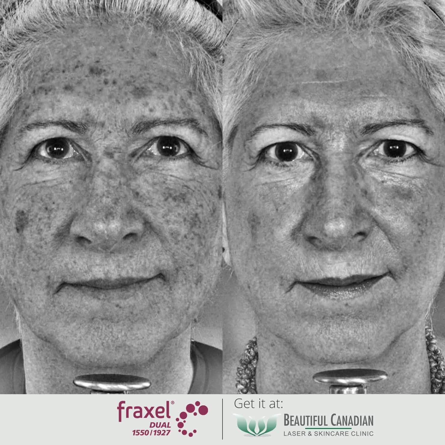 Vancouver Fraxel® DUAL Laser (in Surrey) | Skin Tone & Anti-Aging ...