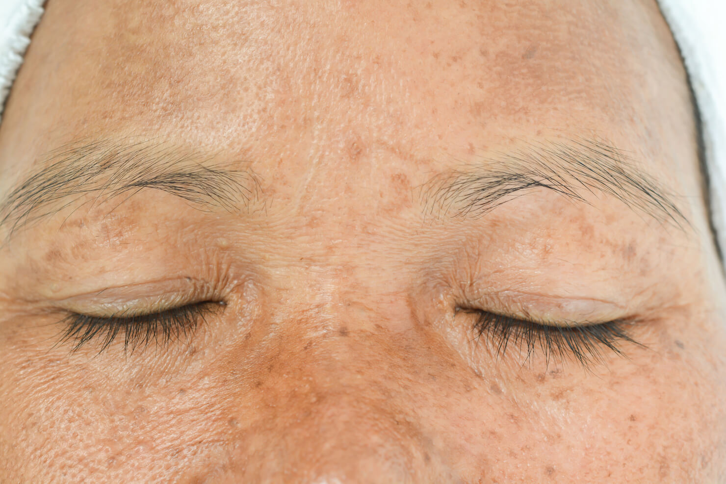 Sun Damage Treatments in Surrey (Vancouver) | Advanced Skin Care ...