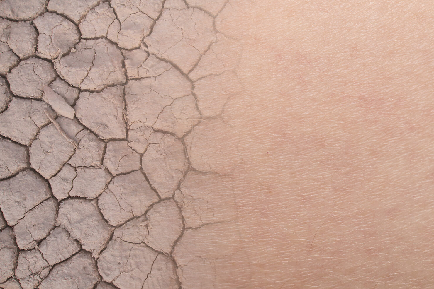 Dry Skin, Dehydrated Skin & Transepidermal Water Loss (TEWL): What They ...