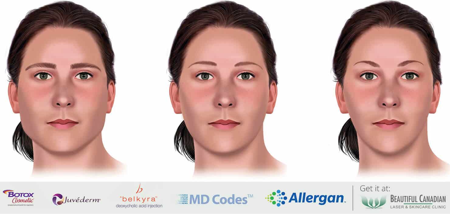 Vancouver (Surrey) Face Slimming: Facial Fat Removal Techniques & How ...