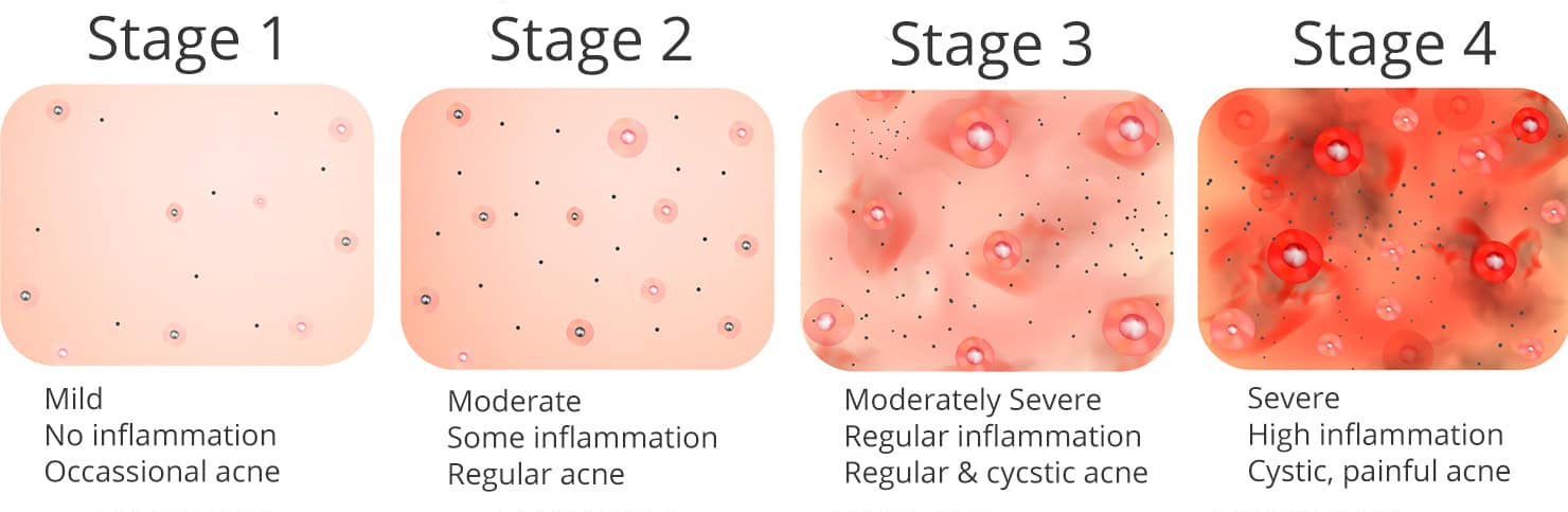 What Causes Acne And How Can I Get Rid Of It?