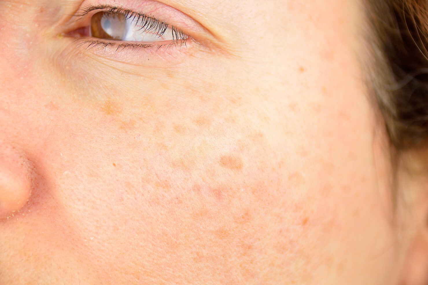 Sun Damage Treatments in Surrey (Vancouver) | Advanced Skin Care ...