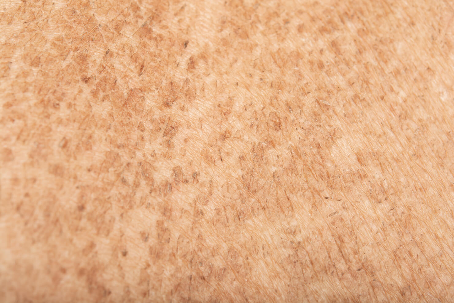 Sun Damage Treatments in Surrey (Vancouver) | Advanced Skin Care ...