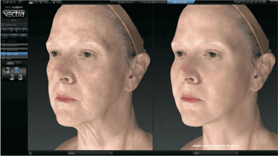VECTRA® 3D Facial Scan | Surrey Skin Clinic | Preview Treatment Results