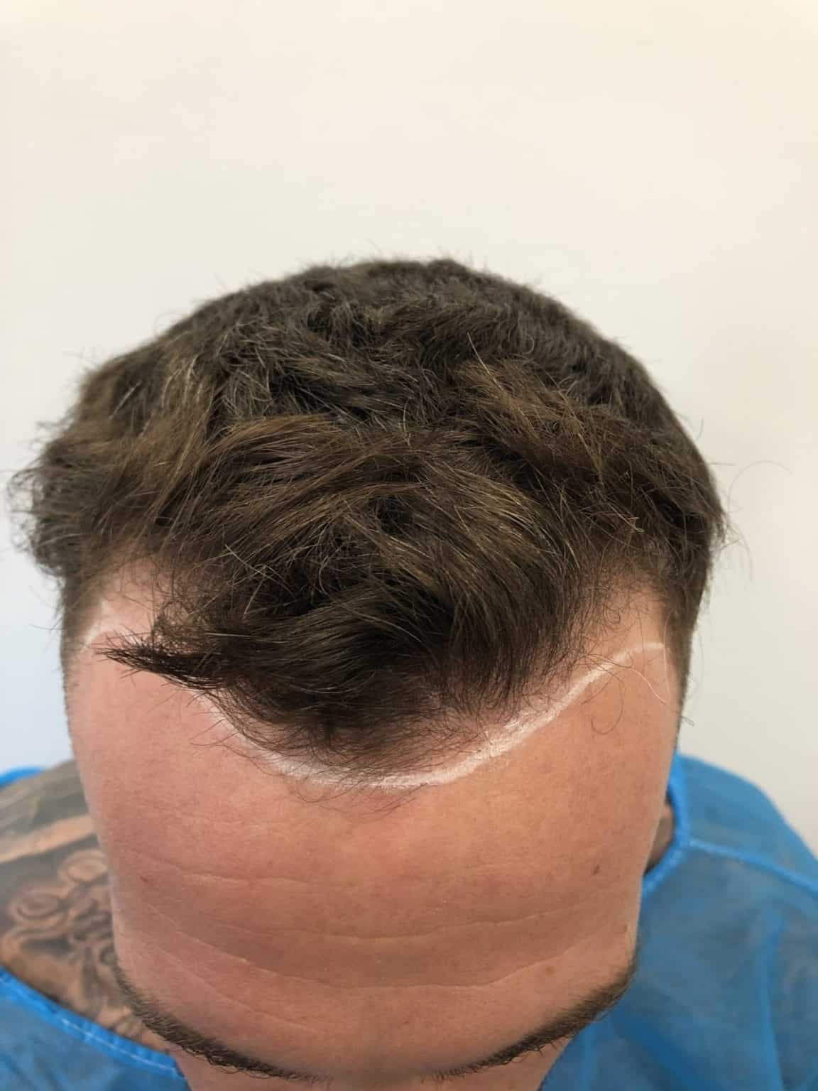 Uneven Hairline? Your 'Wonky Hairline' Treatment Options