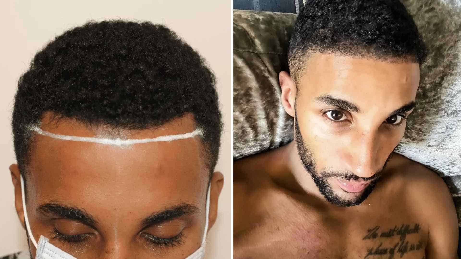 Curly Hair Transplant: Is it Possible?