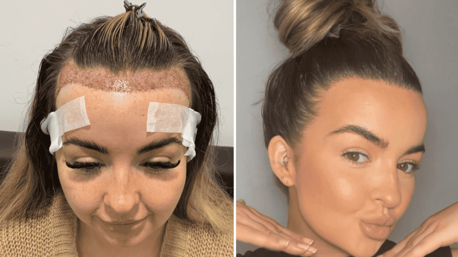 How to Fix a Pushed Back Hairline (Permanently!) - KSL Clinic