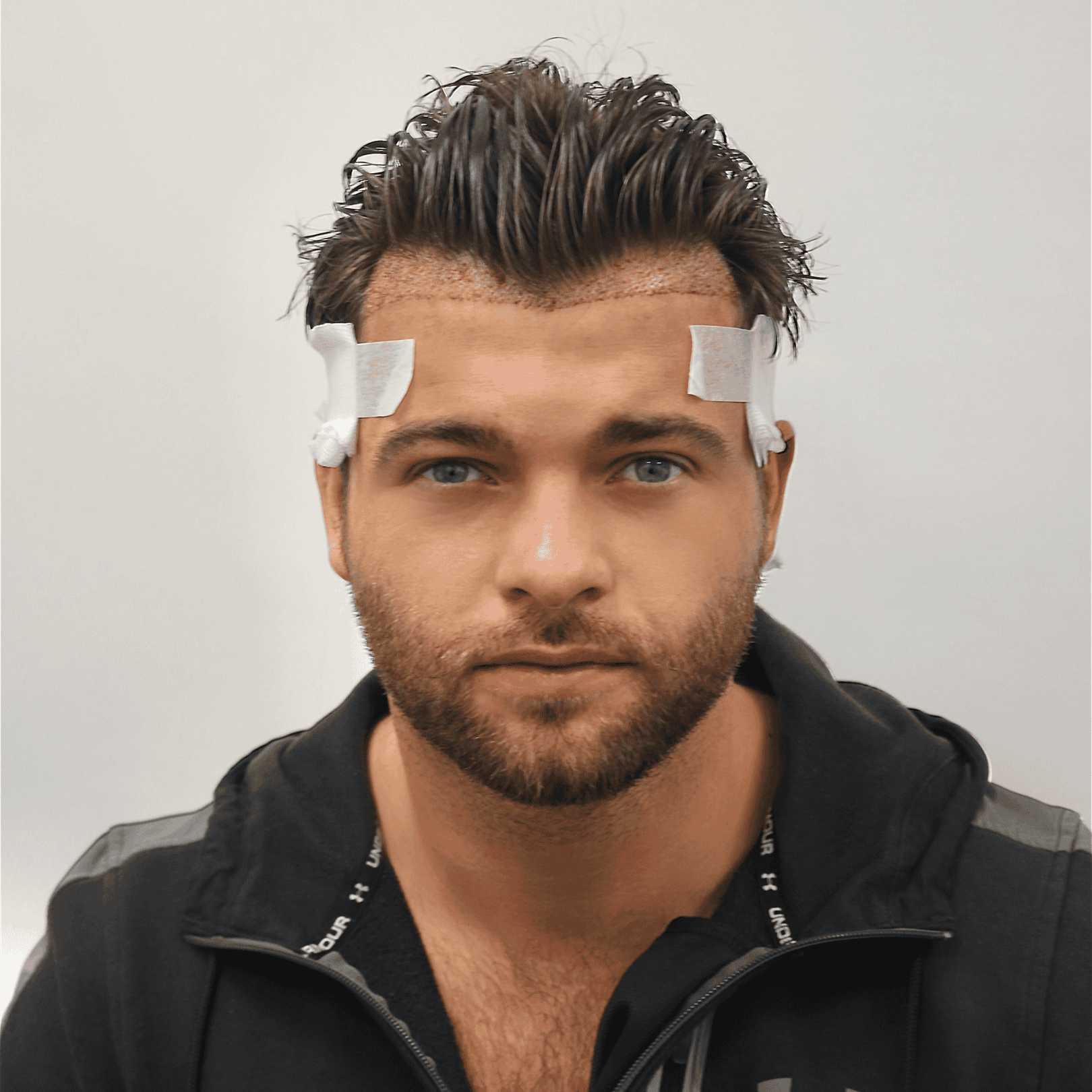 Jake Cornish Hair Transplant at KSL Clinic // See the results here