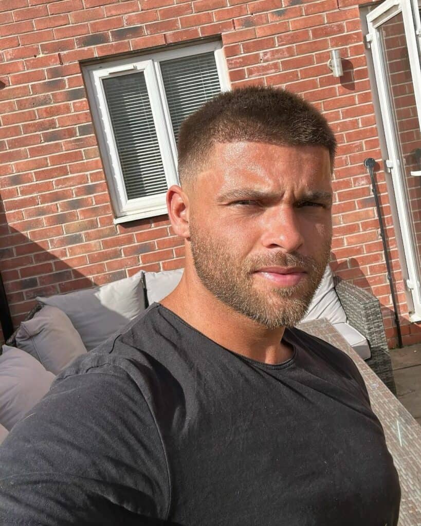 Jake Cornish Hair Transplant at KSL Clinic // See the results here