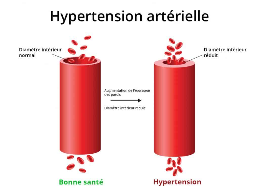 Qu'est-ce que l'hypertension artérielle ? - Le-Tensiomètre.com