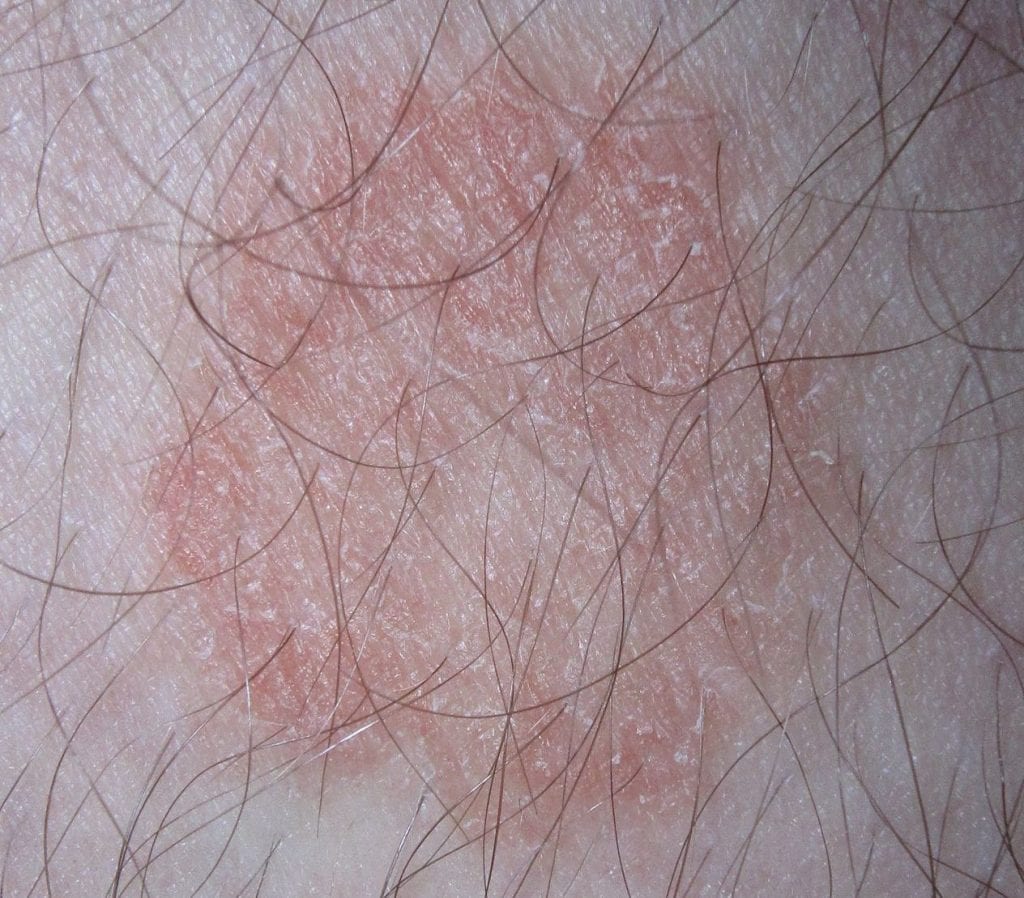 Hautpilz: Infektionswege, Online-Diagnose & Therapie durch Hautärzte