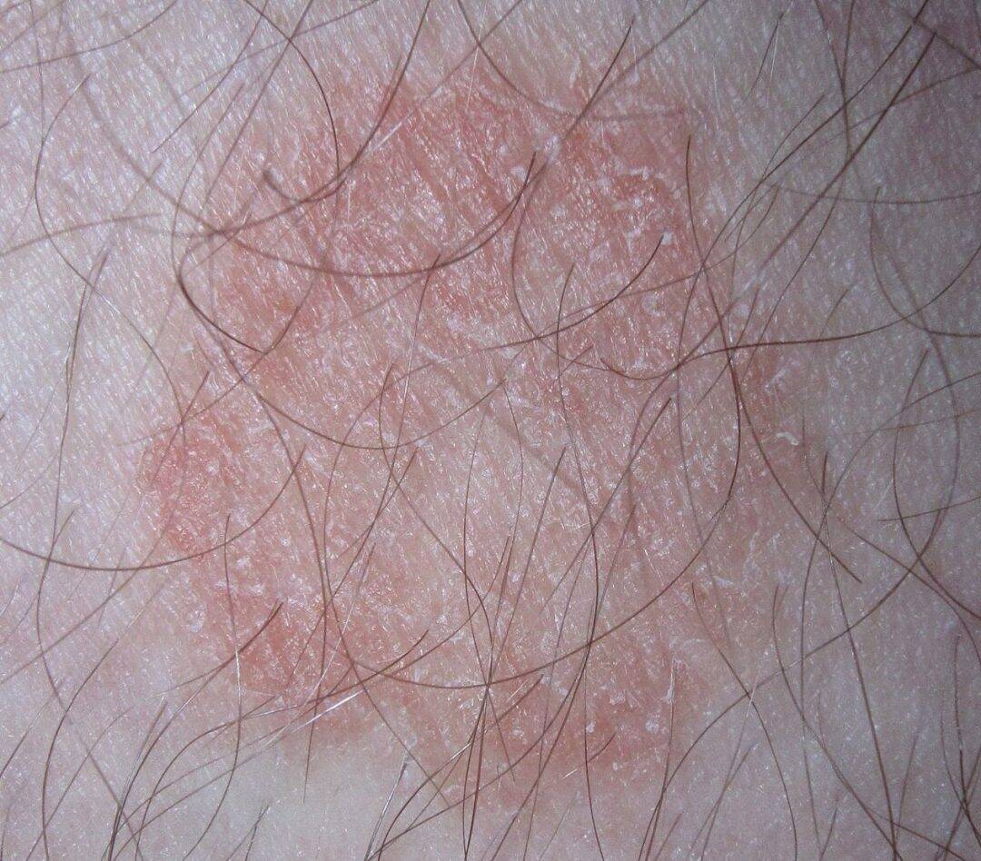 Hautpilz: Infektionswege, Online-Diagnose & Therapie durch Hautärzte