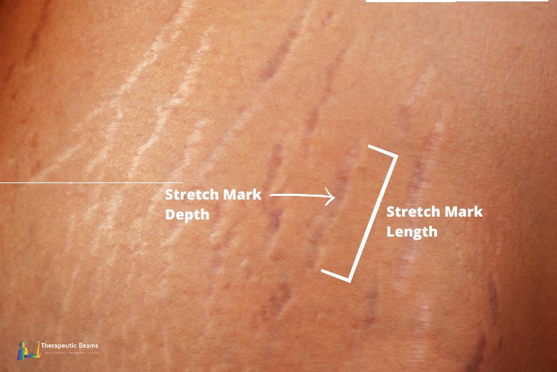 Red Light Therapy For Stretch Marks: Improve Your Skin’s Appearance ...