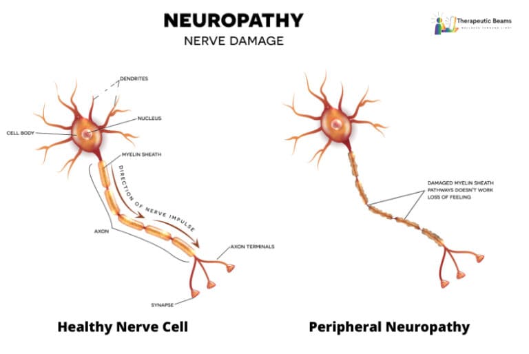 Red Light Therapy For Neuropathy: Putting An End To Neuropathic Pain ...