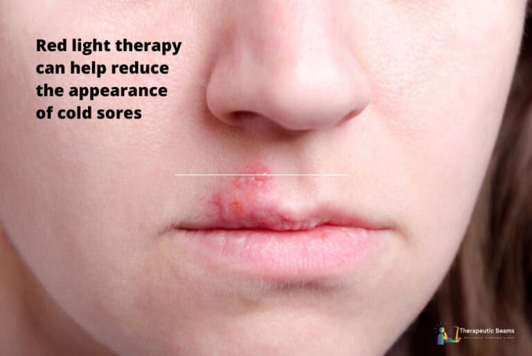 Red Light Therapy For Cold Sores: Say Goodbye To Fever Blisters ...