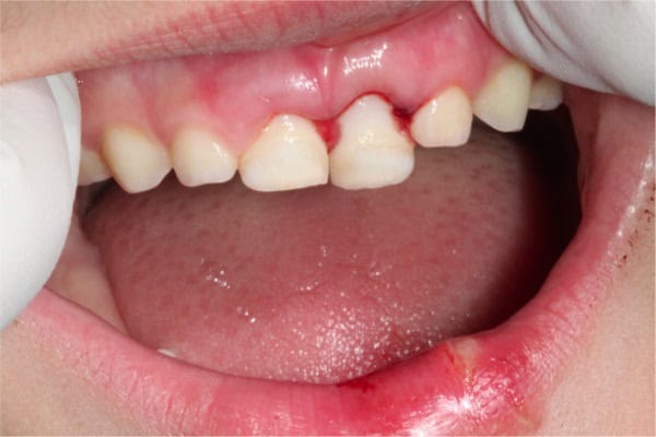 Traumatismo dental: ¿Cómo tratarlo y qué hacer? | Tsastre.com
