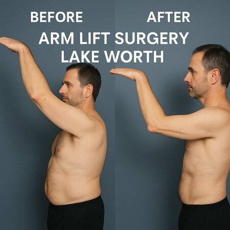 Arm Lift Surgery Lake Worth | Tighten & Tone Your Arms