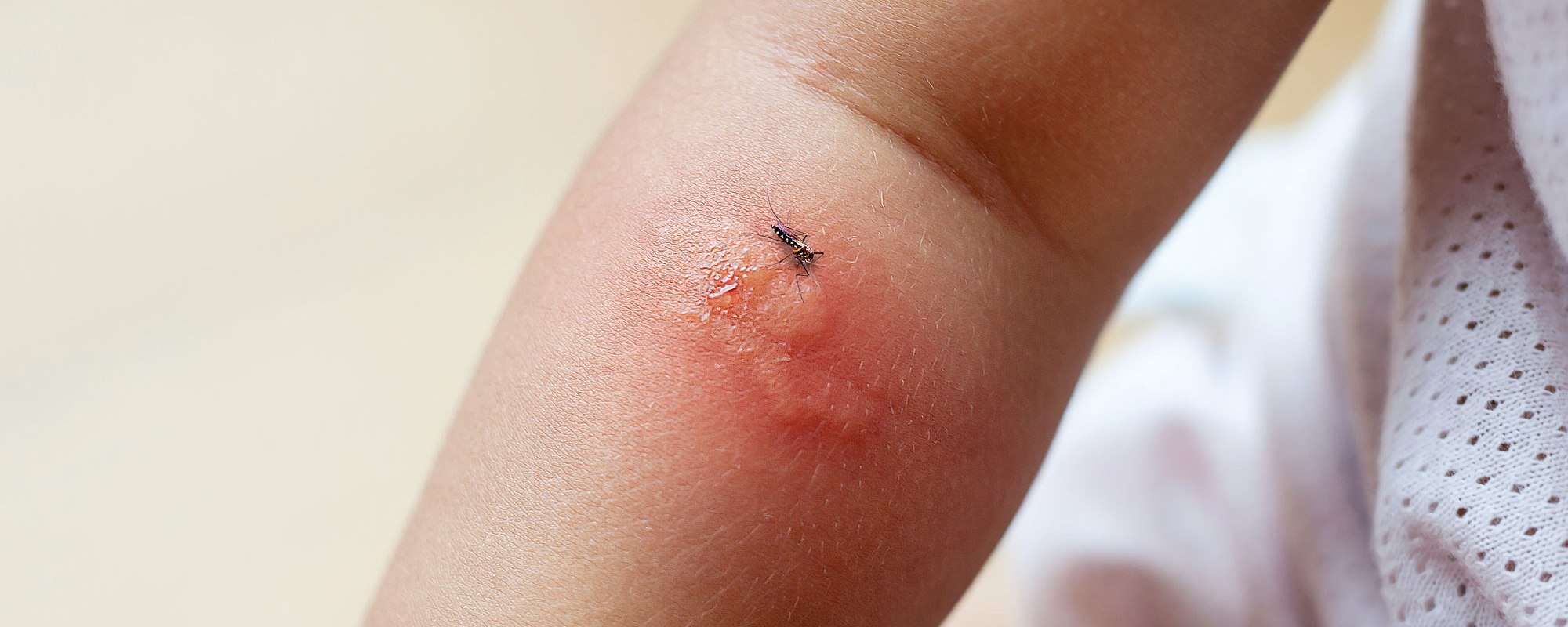 Picaduras De Insetos