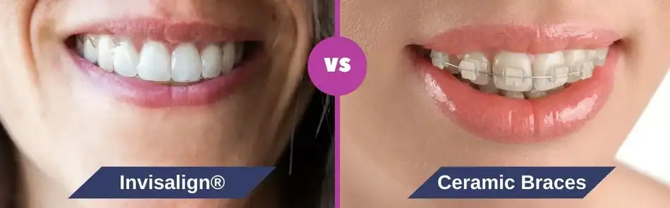 ceramic braces progress