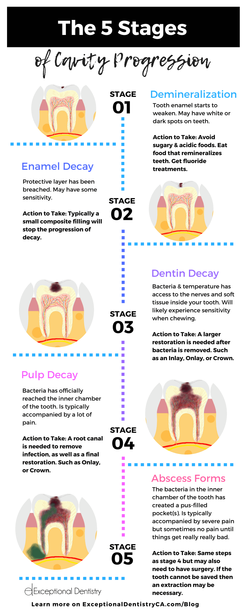 how long does tooth decay take to develop