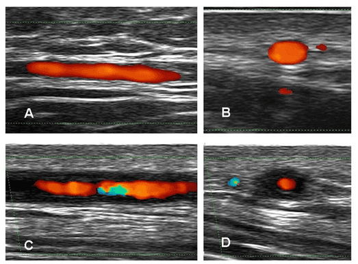 Temporal Artery Ultrasound