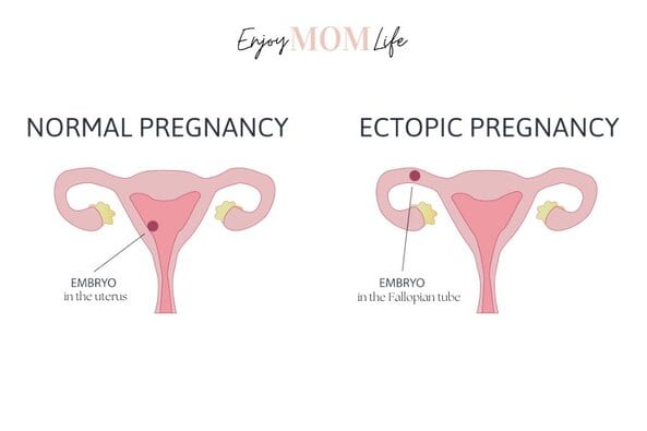Ectopic Pregnancy vs Miscarriage: What's the difference? - Enjoy Mom Life
