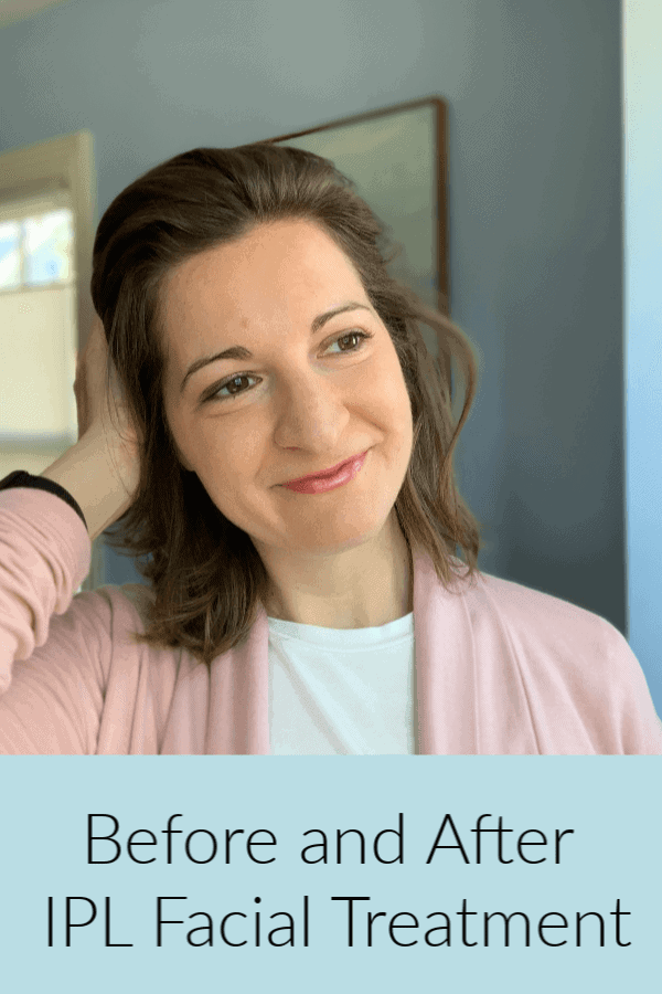 IPL Treatment to Diminish Melasma and Facial Hyperpigmentation. IPL ...