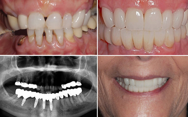 NW Houston Prosthodontics - Dental Reconstruction Gallery