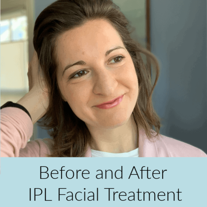 IPL Treatment to Diminish Melasma and Facial Hyperpigmentation. IPL ...