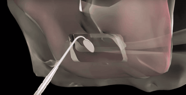 animation teeth surgery