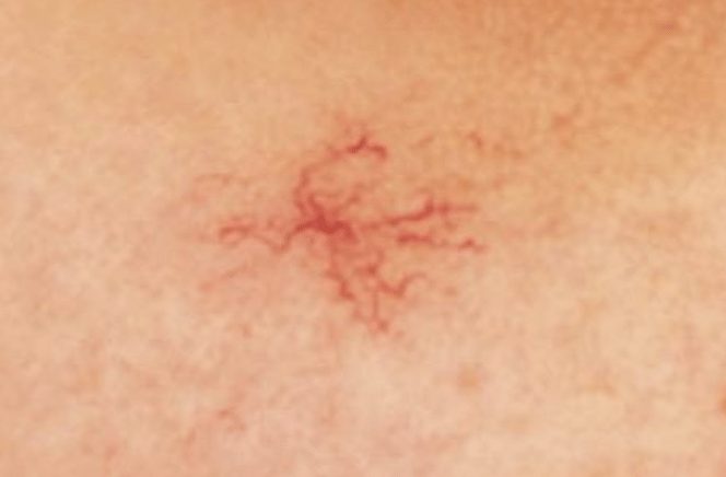 Spider Moles How Many Eyes Do Spiders Have? Rove Pest Control