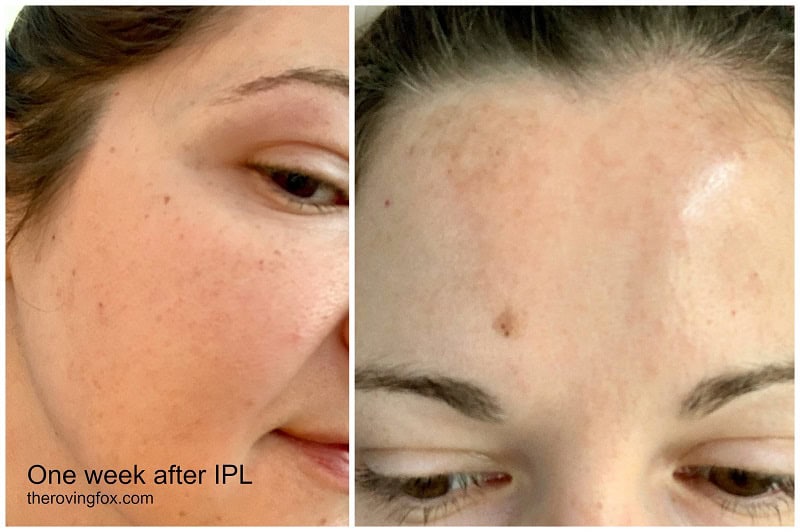 IPL Treatment to Diminish Melasma and Facial Hyperpigmentation. IPL ...