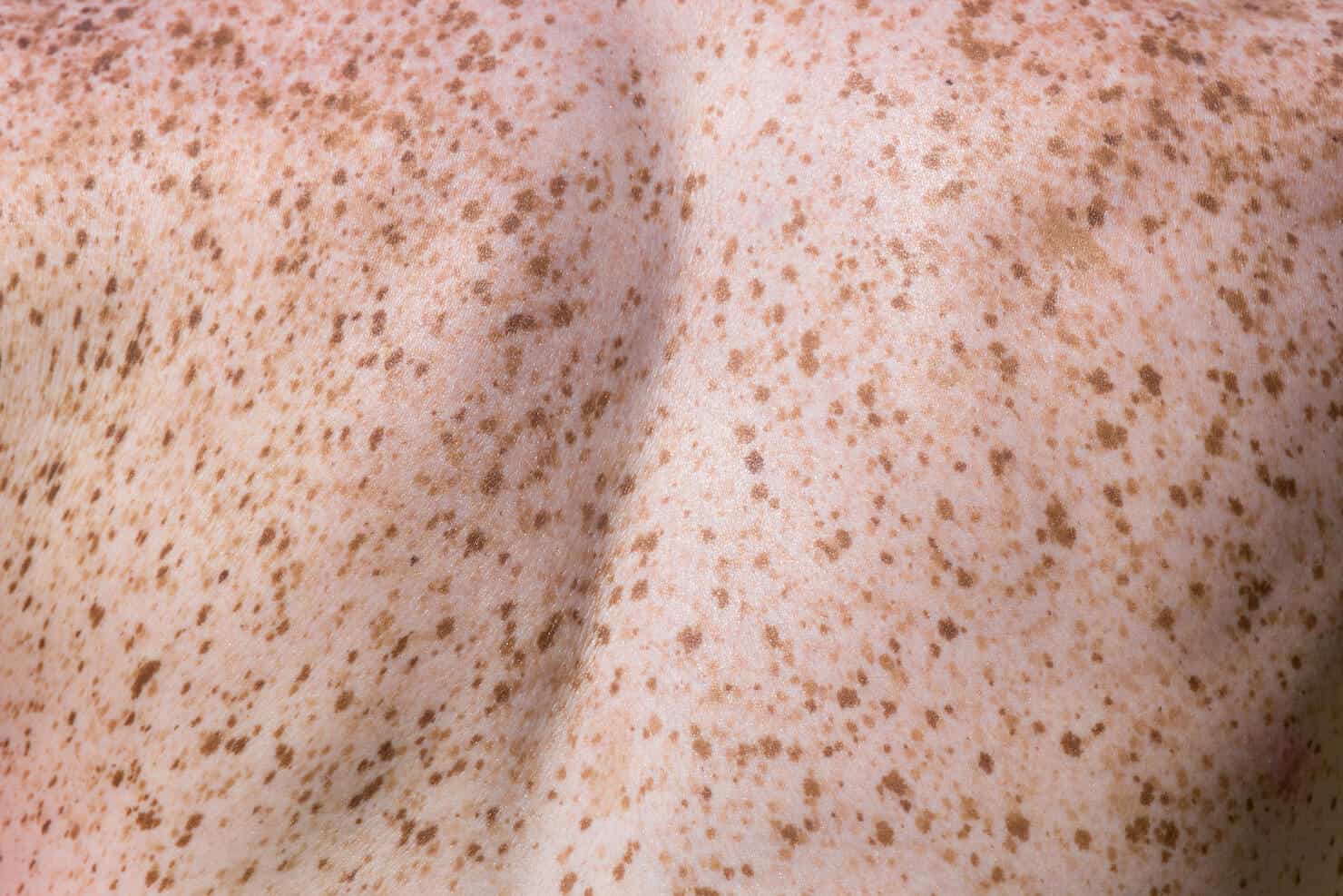 Vancouver Laser Mole Removal & Surgical Removal (in Surrey) | Medical ...