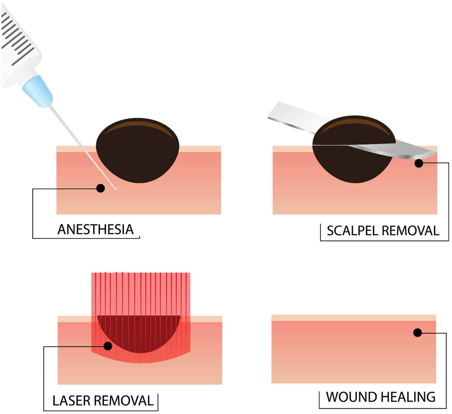 Vancouver Laser Mole Removal & Surgical Removal (in Surrey) | Medical ...
