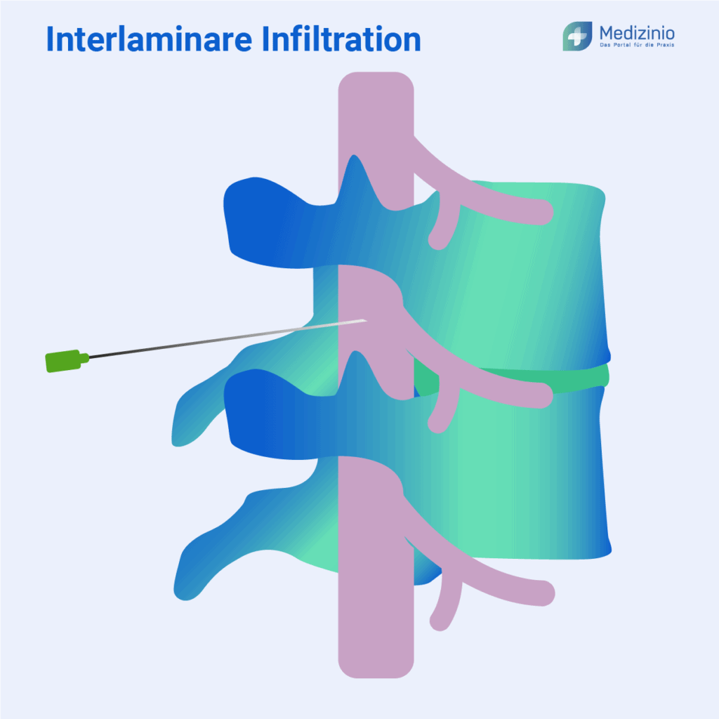 Infiltration Wirbelsäule: Infiltrationstherapie & Diagnostik