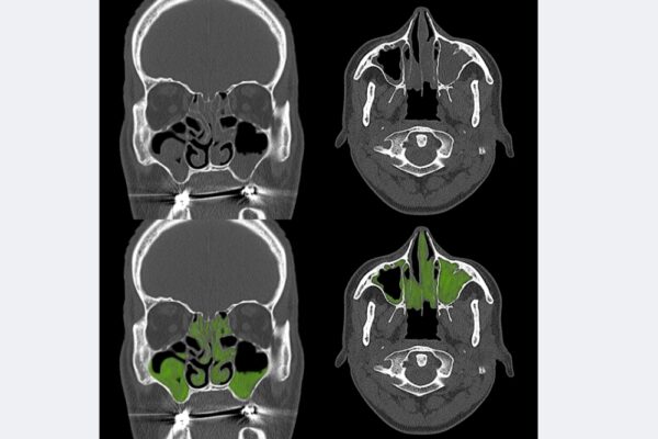 Die Rolle der Computertomographie (CT) in der Medizin