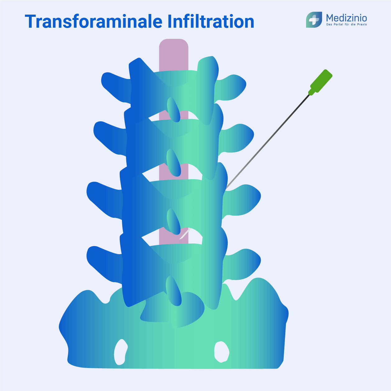 Infiltration Wirbelsäule: Infiltrationstherapie & Diagnostik